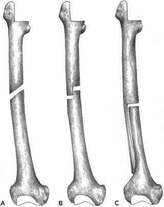 Prosthesis & Allograft Reconstruction – Dr. Jyoti Prakash Orthopaedic ...